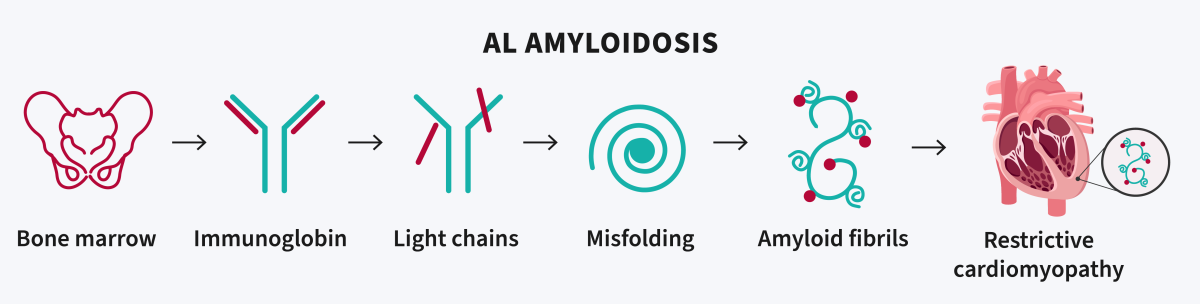 Cardiac Amyloidosis - University of Ottawa Heart Institute