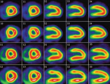 Reducing Radiation in Cardiac Imaging | University of Ottawa Heart Institute