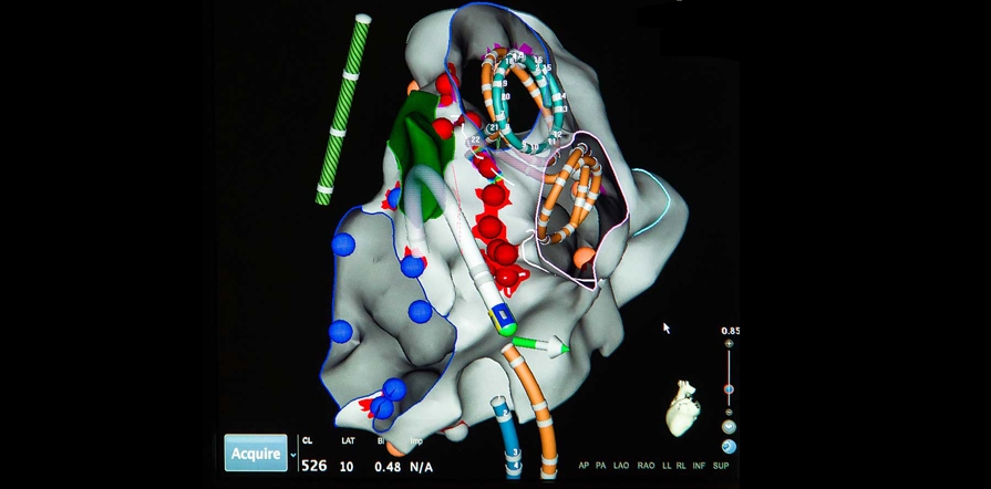 Cardiac Electrophysiology: Repairing the Rhythms of the Heart ...
