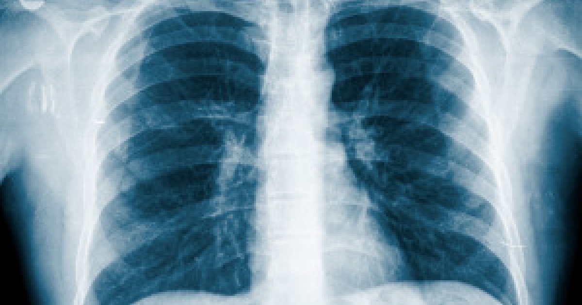 Pneumonia a Risk Factor for Heart Disease | University of Ottawa Heart ...